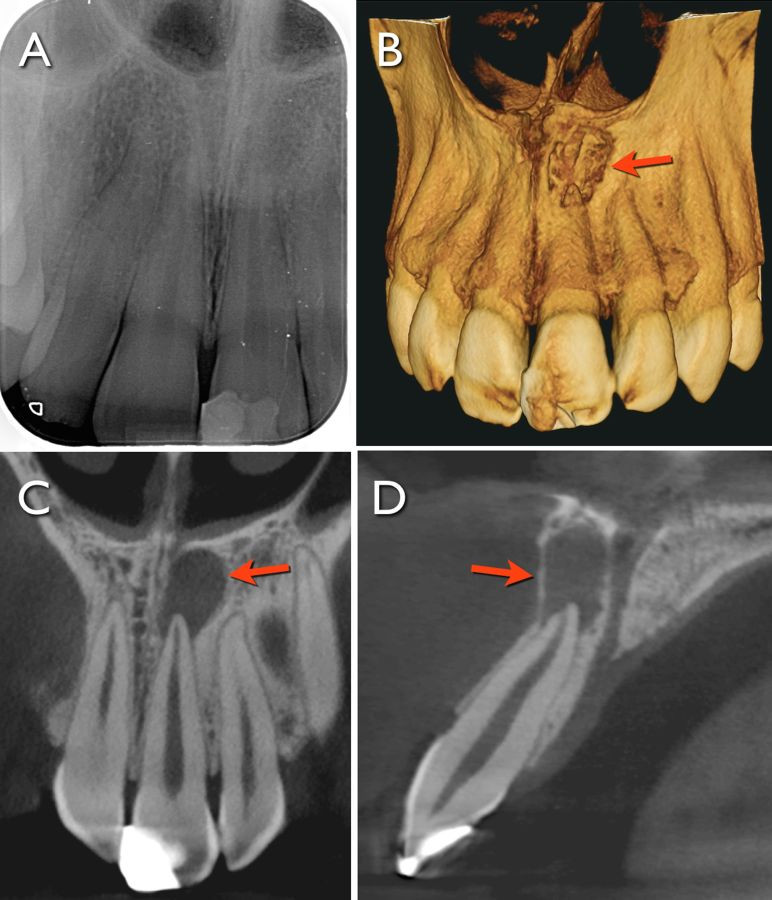 Uso De La Tomografía Volumétrica De Haz Cónico En Endodoncia